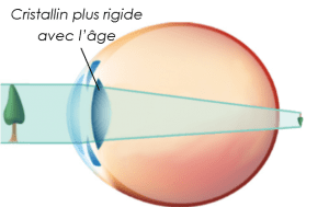 La presbytie et sa correction - EXCEL Vision