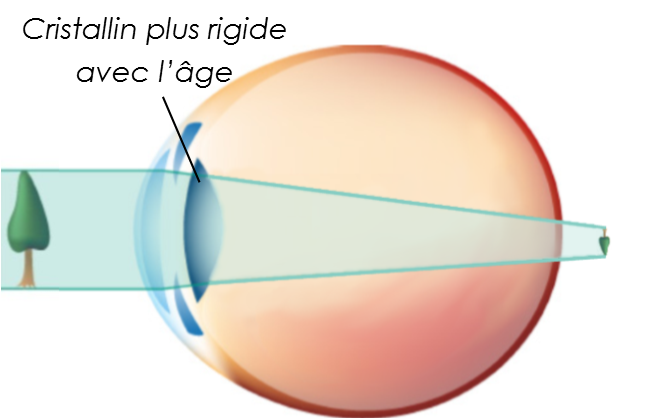 La presbytie et sa correction - EXCEL Vision